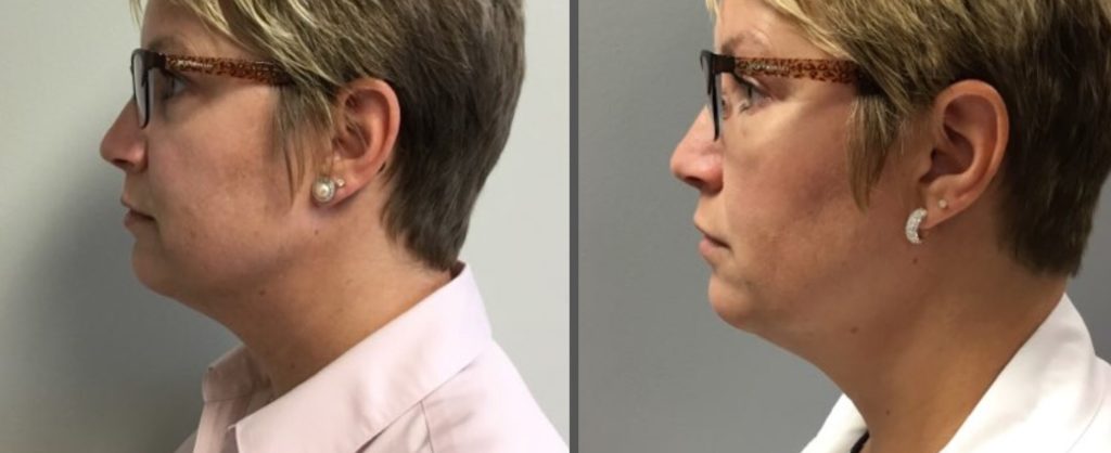 Kybella®